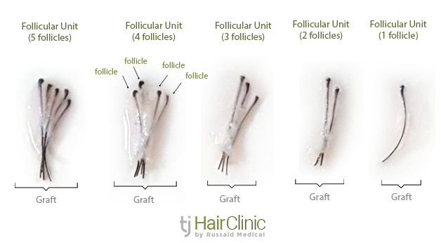 Top 136 How Many Hair In One Graft Of Hair Transplant